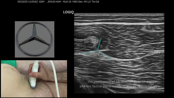 Hamstring Kasları Proksimal İnsersiyo Sorunları - Prof. Dr. Bülent Dağlar