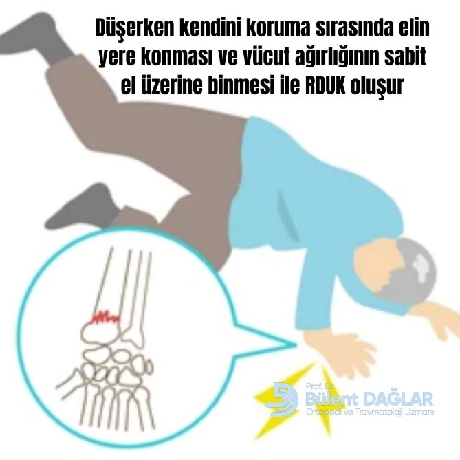 Radius Distal Uç Kırıkları - Prof. Dr. Bülent Dağlar