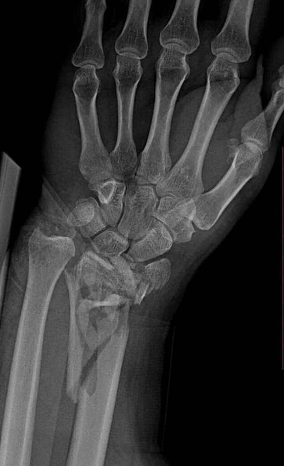 Radius Distal Uç Kırıkları - Prof. Dr. Bülent Dağlar